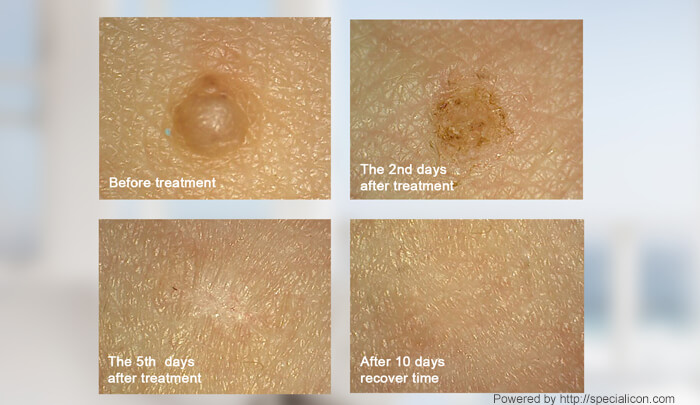 spot remove - Hycoox injector, derma shine pro, oxygeneo pods and ...