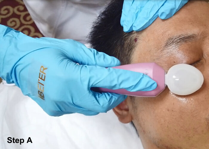 Fractional plasma and RF beauty machine for skin rejuvenation