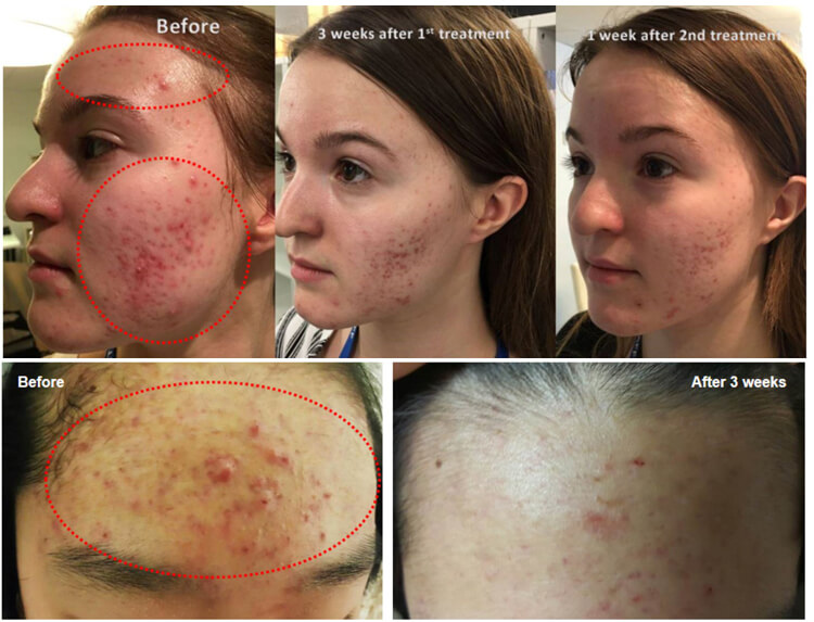 Plasma shower for fibroblast lifting, wrinkle remove and acne remove